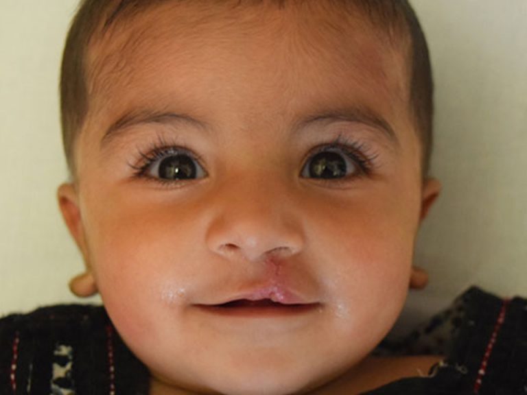 Free Cleft Lip/Palate Surgeries – PWF Pakistan